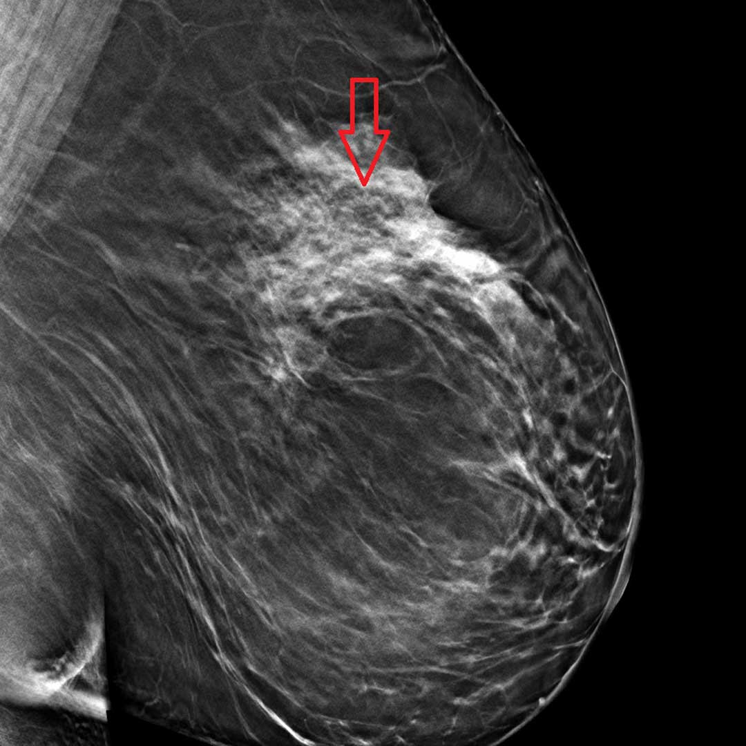 Is my 'questionable distortion' breast cancer? Waiting to find out.